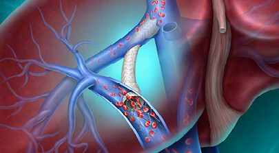 BD Gets CE Mark for Liverty TIPS Stent in EU | Voice of Healthcare